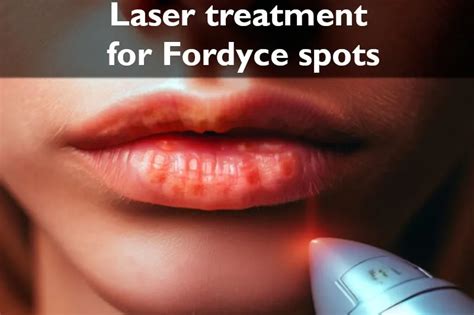 Fordyce Spots Medical Treatments 6 Expert Medical Solutions