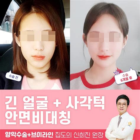 이유 구강악안면외과 치과의원 💕뼛속까지 예쁜 이유💕 외모적 고민 긴 얼굴 사각턱
