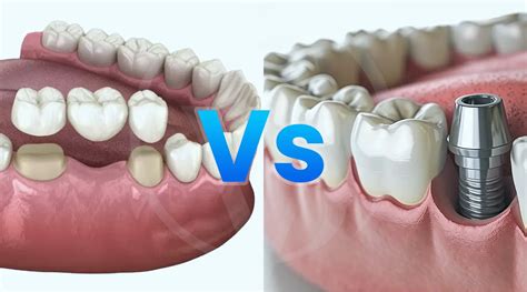 Dental Bridges Vs Dental Implants Whats The Real Cost Of Choosing Wrong