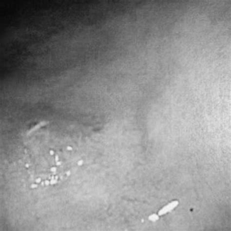 Pdf Sigmoid Colon Polyp As Initial Presentation Of Metastatic Papillary Renal Cell Carcinoma