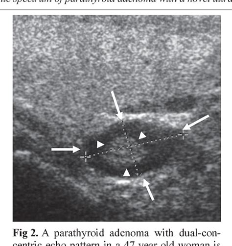 Figure 1 From Variable Sonographic Spectrum Of Parathyroid Adenoma With