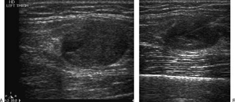 A Ultrasound Demonstrates A Partially Cystic Soft Tissue Tumor In The