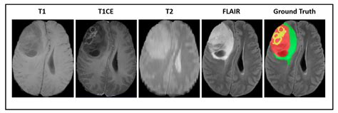GitHub Alimpan ML Project Brain Tumor Segmentation
