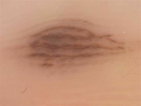 Age Related Prevalence Of Dermatoscopic Patterns Of Acral Melanocytic