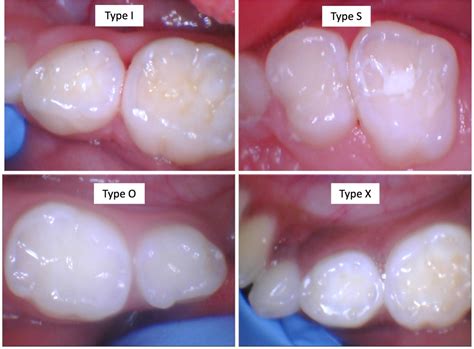 Journal Of Clinical Pediatric Dentistry Jocpd