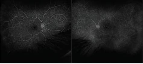 Uveitis Icd 10 Approaches For Anterior Uveitis Optometric Management