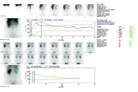 Radionuclide Dynamic Renal Imaging Examination The Figure Shows That
