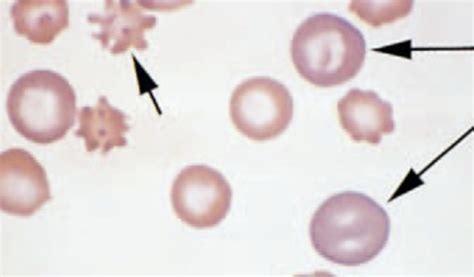 Clin Path Erythrocyte Morphology Flashcards Quizlet