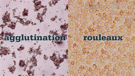 How To Perform A Saline Agglutination Test Youtube