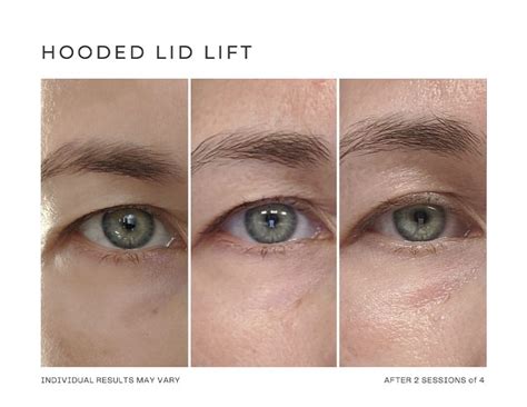 Fibroblast Treatments In Dallas Tx Genesis Lifestyle Medicine