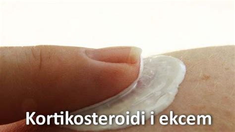 Lečenje Ekcema Kortikosteroidima Ekcem I Kortikosteroidi
