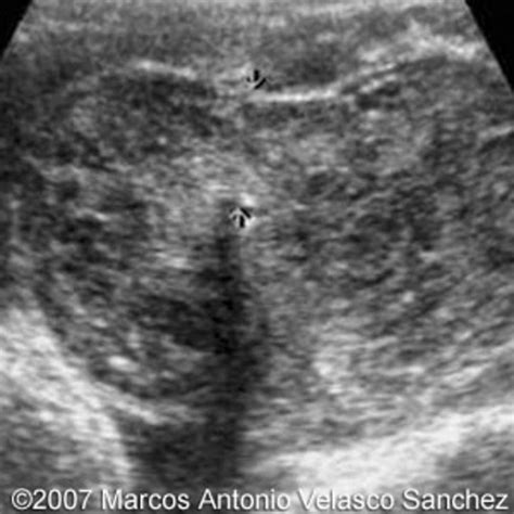📃 Cephalocele Anterior