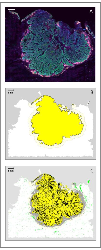 Multiplex Immunofluorescence Combined With Spatial Image Analysis For The Clinical And