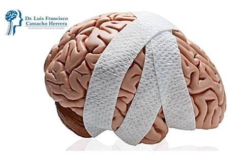 ¿qué Sabe Sobre Lesiones Cerebrales Traumáticas Dr Camacho