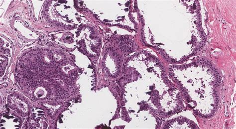 Atypical Ductal Hyperplasia Archives Ottawa Atlas Of Pathology