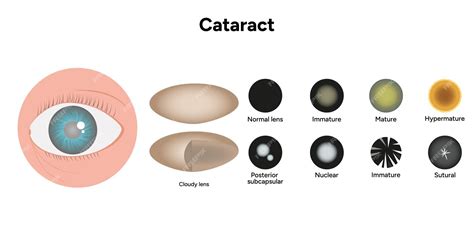 Premium Vector Type Cataract With Human Zoom Eye And Cloudy Lens