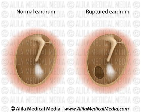 Alila Medical Media Ruptured Eardrum Medical Illustration