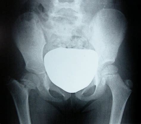 Anteroposterior Radiograph Of The Pelvis Shows Coxa Vara And Growth