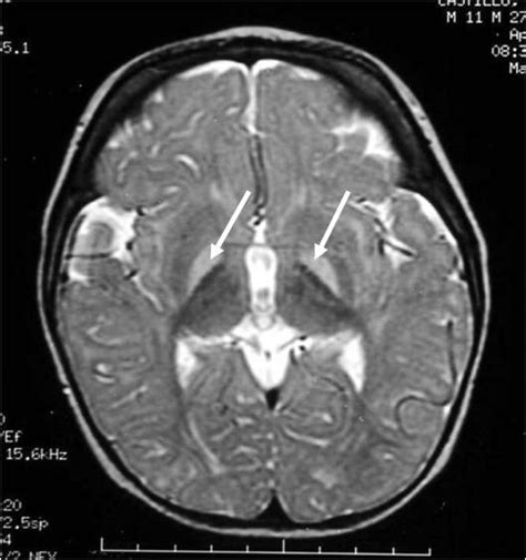 Bind Score In Severe Hyperbilirubinemia Epomedicine