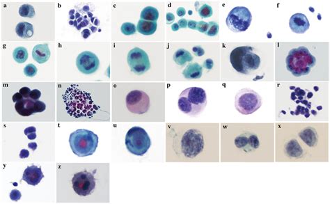 Malignant Cells In Csf