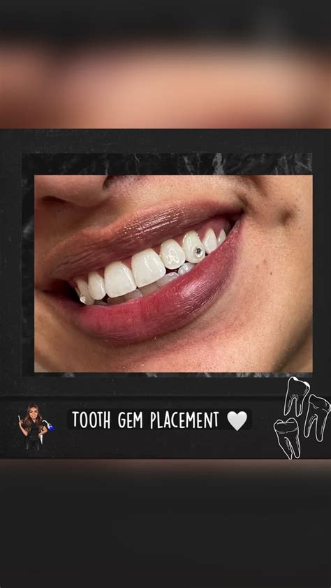 Tooth Gem Placement 🤍 Tooth Gem Placement Tooth Gem Teeth Whitening