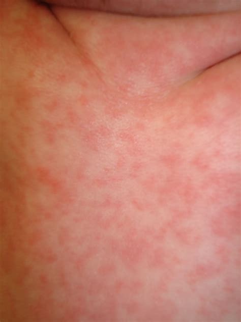 Viral Rash Types Pictures Symptoms Treatments