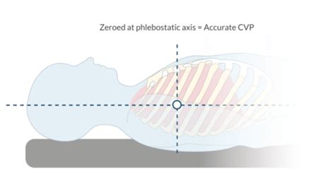 CVP Interpretation Abnormal CVP Flashcards Quizlet