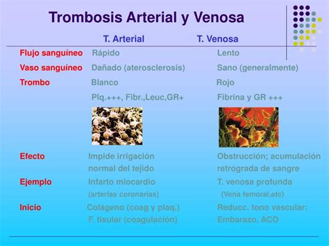 Trombose Arterial Vs Trombose Venosa