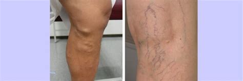 Varicose Veins Vs Spider Veins Understanding The Difference VaricoseveinsIndia