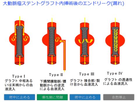 エンドリークとは？ ギモンらど！！