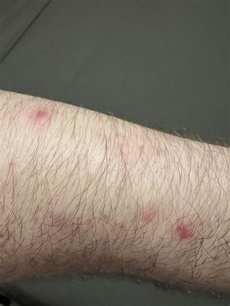 Stubborn Forearm Acne R Acnetreatments