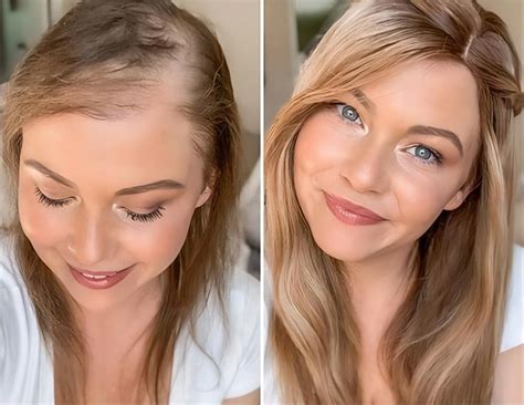 What Is The Best Wig For Baldness And Thinning Hair Wigshe