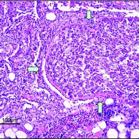 Photomicrograph Of A Paraffin Embedded Section Of A Biopsy Specimen Of