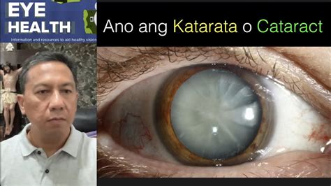 Ano Ang Katarata O Cataract Youtube