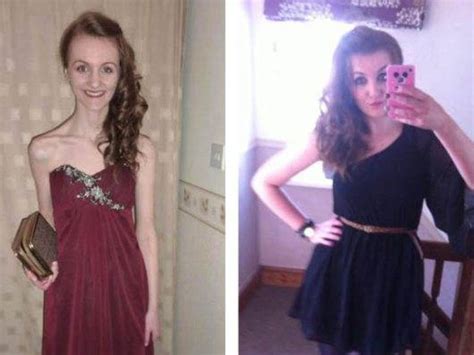 15 Amazing Girls Who Beat Anorexia Gallery Ebaums World