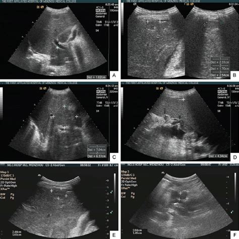 High Resolutions B Mode Ultrasonography Of The Liver Showed Multiple