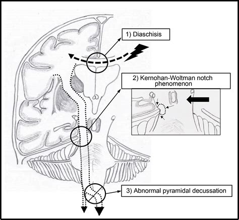 Kernohan Woltman Notch Phenomenon An Exceptional Neurological Picture