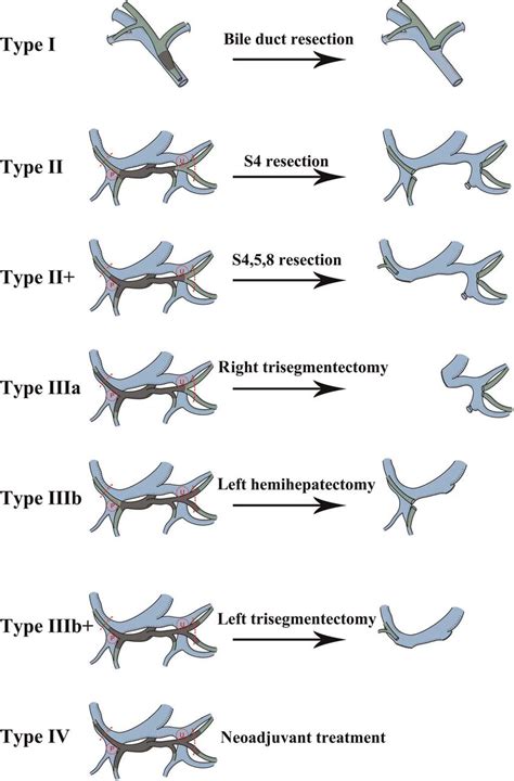 Modified Classification Of Hilar Cholangiocarcinoma And The Download Scientific Diagram