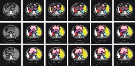 Qualitative Results On Synapse Dataset All Columns Respectively