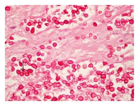Pas Stain Of Mesenteric Lymph Node Biopsy Showing Yeasts 1000x