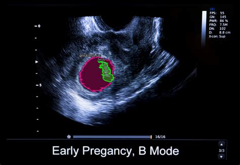 Data Annotation Is Enabling The Development Of Surgical Ai Keymakr