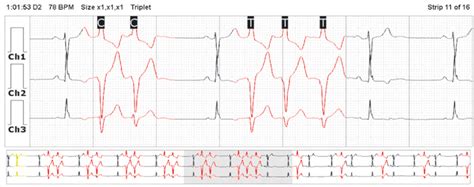 Fragment Of Multi Day Electrocardiographic Monitoring Download Scientific Diagram