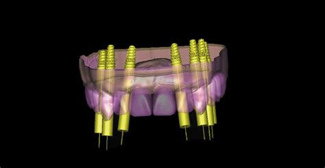 Cirugía de implantes guiada por ordenador Autrán Dental