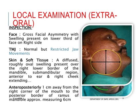 Case Of Epidermoid Cyst In Mandible A Rare Entity And Review Ppt