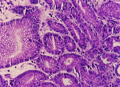 The Rockefeller University The Nutrient That Cancer Cells Crave