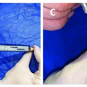 Measuring With A Digital Caliper Where The Results Were 3 Mm Download Scientific Diagram