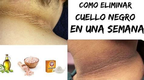 Como Eliminar Cuello Negro En Una Semana YouTube