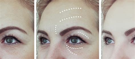 Reversing Aging Signs Combining Dermal Fillers And Botox In Calgary