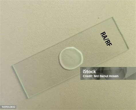 Positive Rf Test On Slide By Latex Agglutination Method Diagnosis For