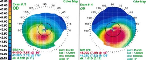 Preoperative Left Topography Right Eye And Right Topography Left Download Scientific